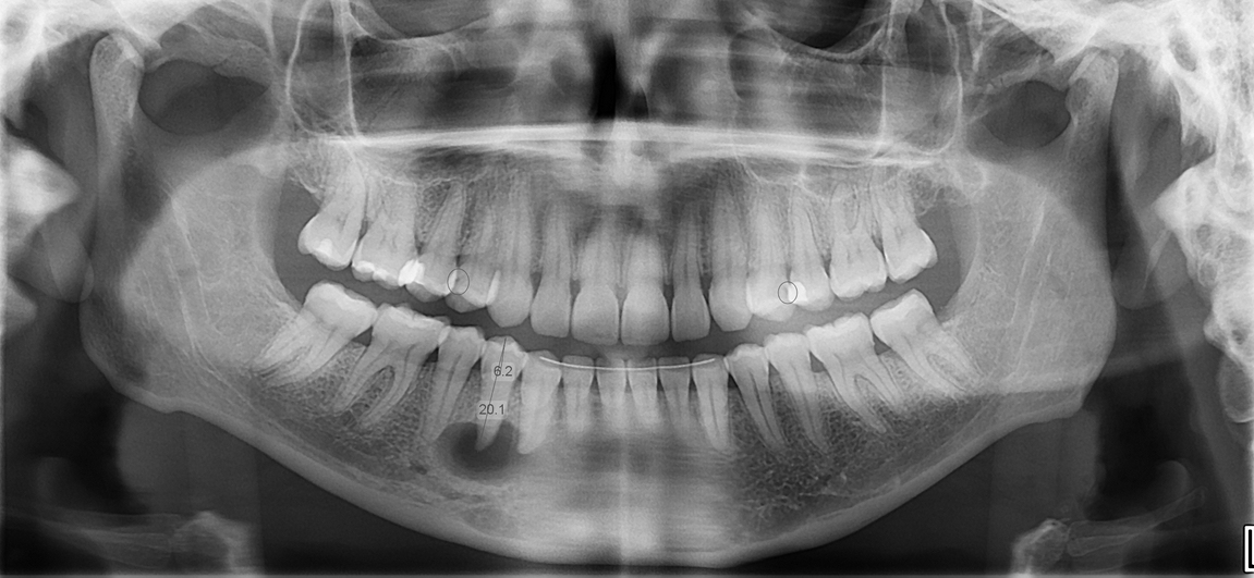 Endodoncia, lesiones periapicales y regeneración ósea - Araujo
