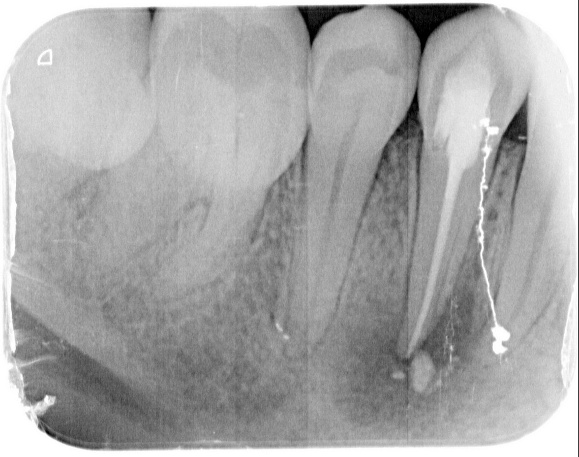 Endodoncia, lesiones periapicales y regeneración ósea - Araujo
