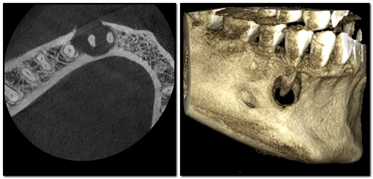 Endodoncia, lesiones periapicales y regeneración ósea - Araujo